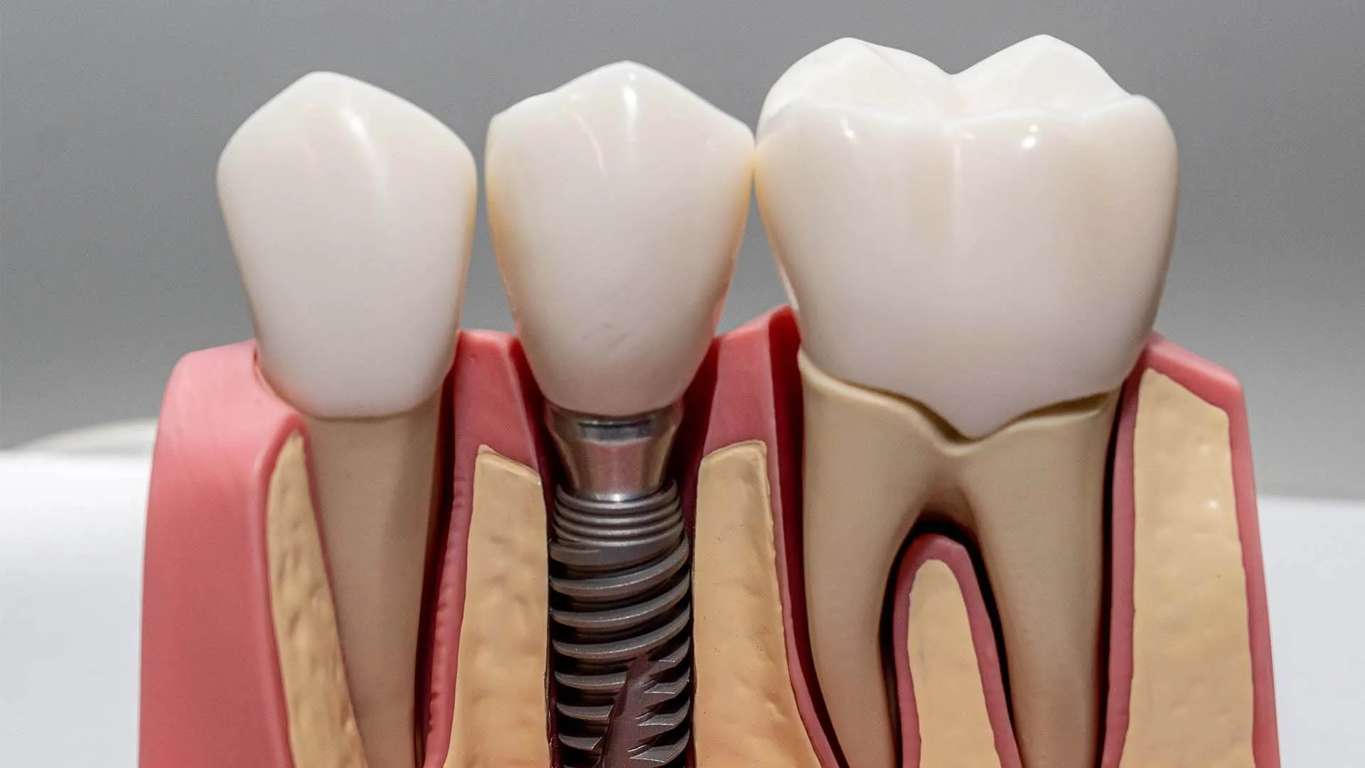 Dental Implants | Smiles Dental Group | Edmonton Dental Implants | Smiles Dental Group | Edmonton