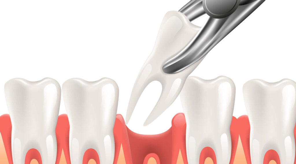 When Does A Tooth Need To Be Pulled? | Dentists In Edmonton & Area ...