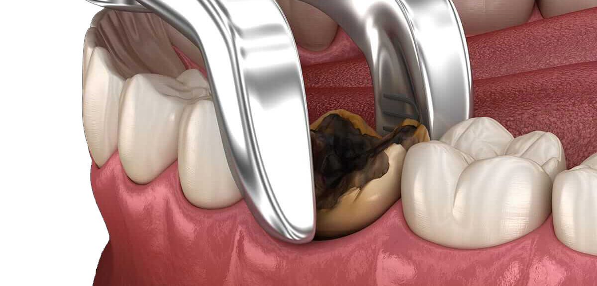 Tooth Extractions - Everything You Need To Know | Smiles Dental Group