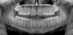 What Is Lockjaw? The Symptoms, Causes, And Treatment | Dentists In ...