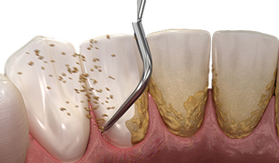 Does Sugar Rot Teeth? Lets Find Out | Dentists In Edmonton & Area ...