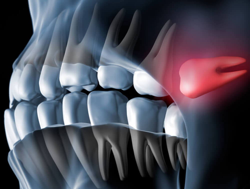 Wisdom Teeth - Reasons, Complications, Solutions | Dentists In Edmonton ...